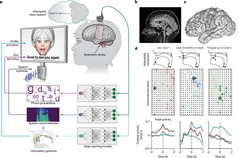 brain computer interface enables woman with severe paralysis to speak