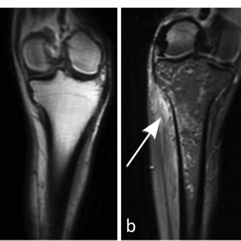 A B Coronal Mri Of The Tibia And Fibula T1 Weighted Image A