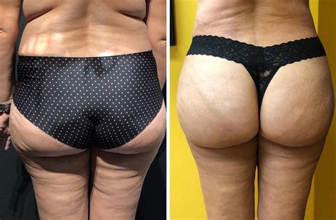 Bbl Before And After Pictures What Should You Look For