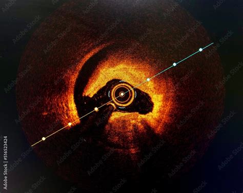 Intravascular Imaging Optical Coherence Tomography OCT Shown Dissection In Coronary Artery
