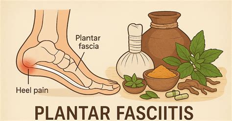 Treatments In Ayurveda My Clinical Experiences Plantar Fasciitis Or