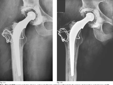 Figure 2 From Results Of Charnley Total Hip Arthroplasty At A Minimum