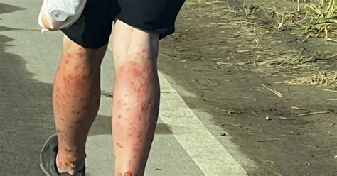 스치기만 해도 위험…잼버리 대원들 물집 투성이 된 이유