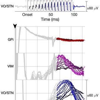 A Front Left And Back Right Views Of The DBS Lead Implant Download Scientific Diagram