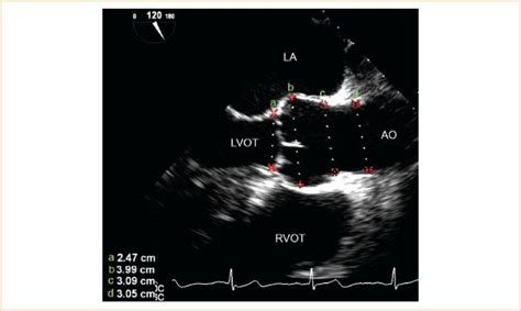 Aortic Regurgitation Radiology Key