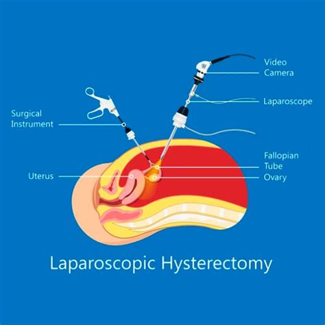 Laparoscopic Hysterectomy Procedure Steps