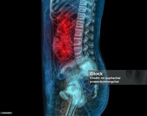 Ct Colonography Or Ct Scan Of Colon 3d Rendering Image For Screening Colorectal Cancer Check Up