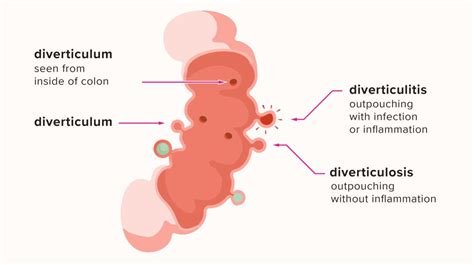 Diverticulitis Flare Up Symptoms And Risks Artofit