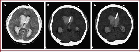 Figure 3 From Intraventricular Hemorrhage Secondary To Intranidal Aneurysm Rupture—successful