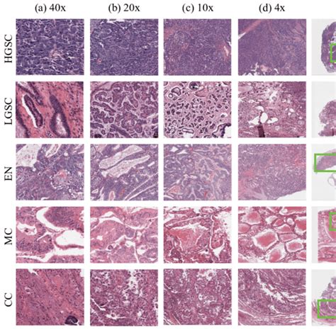 Ovarian Cancer Subtype Classification Kaggle