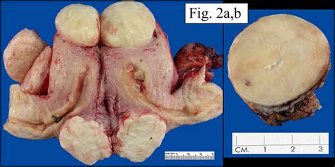 April 2009 A 43 Yo Woman With Multiple Uterine Masses And Left