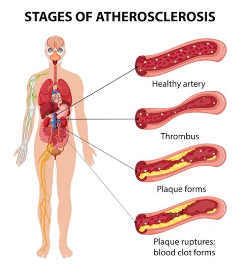 Infografik Zu Den Stadien Der Arteriosklerose Kostenlose Vektor