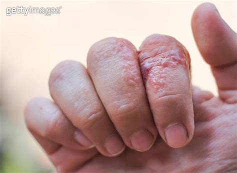 Allergy Symptom Rash And Blister On Finger Right Hand Asian Woman 이미지