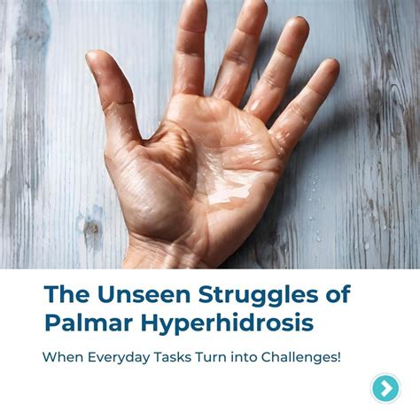 The Unseen Struggle Of Palmar Hyperhidrosis R Dermadry