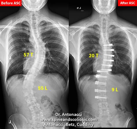 Degree Scoliosis Cervical Curve