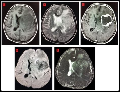 A T1w Axial B T2w Axial C T1w Post Contrast Axial D Diffusion