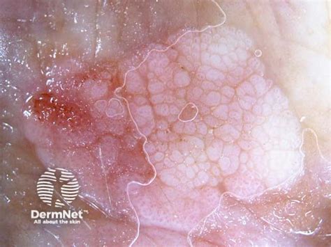Genital Wart Images Dermnet Nz Warts MySkinDoctor