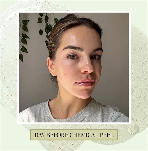 How Chemical Peels Transform My Skin The Everygirl