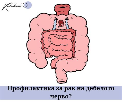 Как да познаем рака на дебелото черво МЦ Д р Калчев