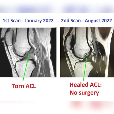 Physio Network On Twitter 1 A Thread 🧵 About Acl Rupture When I Get That Feeling I Want