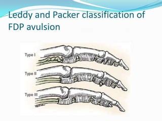 Flexor Tendon Injuriesutsav Pptx