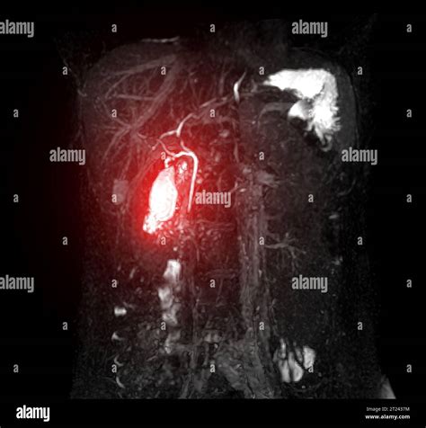 Magnetic Resonance Cholangiopancreatography Or Mrcp Showing Gallbladder Biliary And Pancreatic