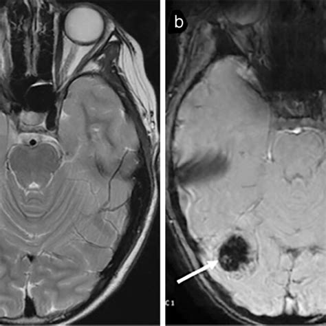 Polymorphous Low Grade Neuroepithelial Tumor Of The Young Plnty In A