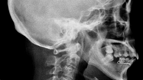 Arnold Chiari Malformation Radiology Insights