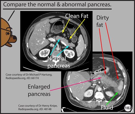 Abdominopelvic Ct