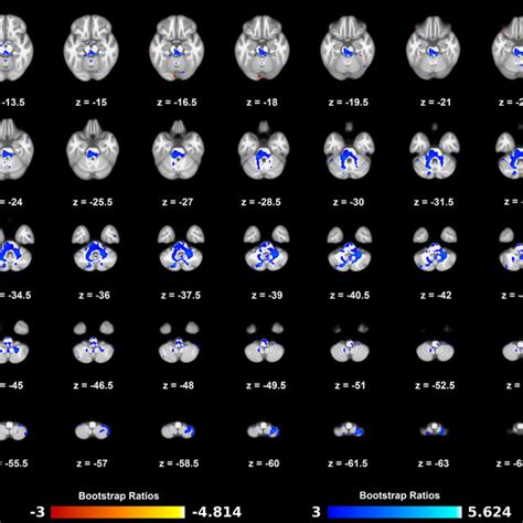Brain Deformation Associated With The Brainstemcerebellum Pattern The