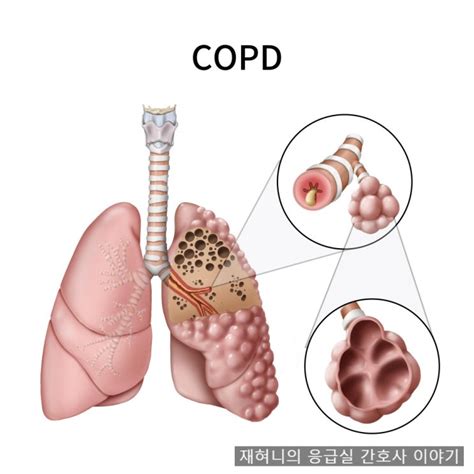 만성폐쇄성 폐 질환copd 기관지염 폐기종의 응급실 처치 네이버 블로그