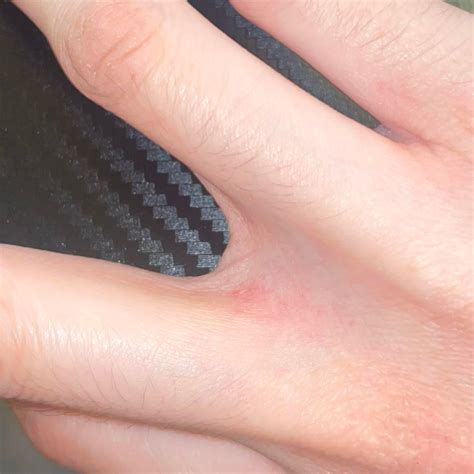 Red Itchy Spot Between Fingers Rdermatologyquestions
