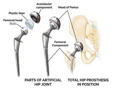 Unilateral Hip Replacement Surgery Regain Mobility