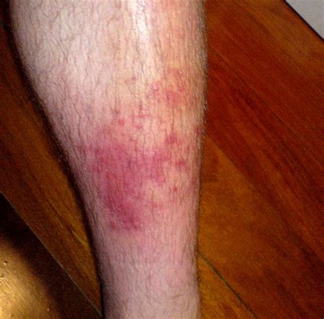 Cellulitis Of The Legs Pictures Photos