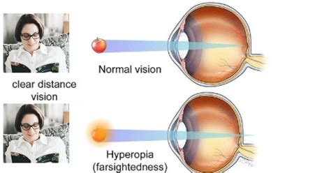 Understanding Hyperopia Causes Symptoms And Treatment Options For Farsightedness