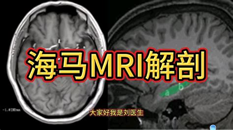 影像基础：海马mri解剖分享讲解，2分钟学会！ 哔哩哔哩