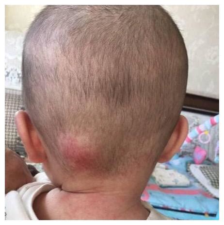 3个多月宝宝后脑勺起了一个大包医生怒斥不该妈妈悔恨交加 娜娜 后脑勺 宝宝 新浪新闻