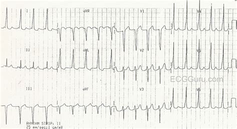 Kent Bundle Ecg Guru Instructor Resources