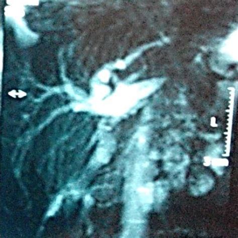 Mrcp Showing Dilated Intrahepatic Biliary Radicals And Common Bile Duct
