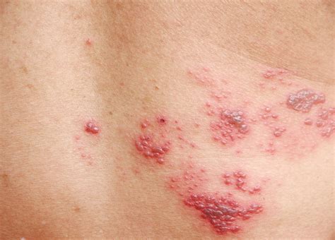 Shingles How To Spot The Typical Symptoms DocFinder Co Uk