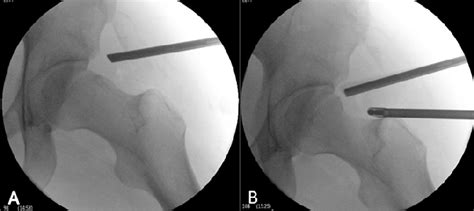 Figure 2 From Femoral De Rotation Osteotomy Versus Hip Arthroscopy For Management Of