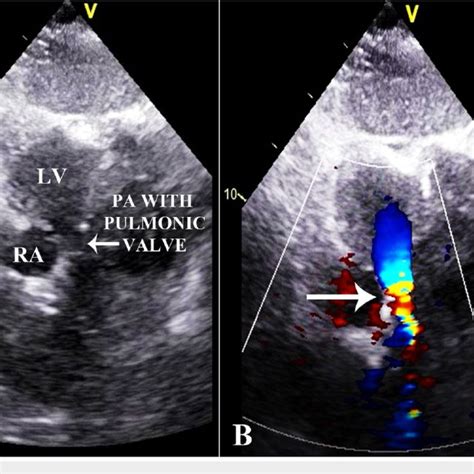 Echocardiogram Apical Four Chamber View Showing Right Atrium Ra