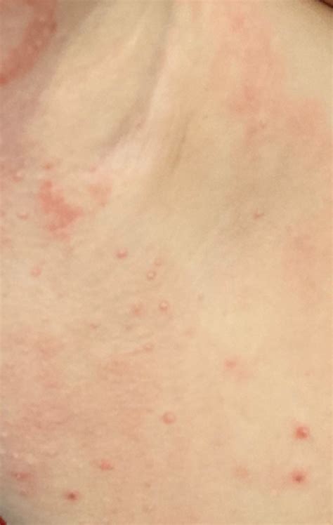 Molluscum Water Warts Dell Warts Mellescum Moloscum Muloscem Mollenol