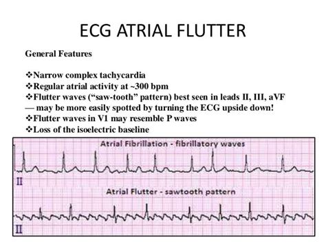 Atrial Flutter Litfl Ecg Library Diagnosis