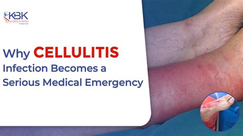 Cellulitis When To Worry Signs And Risks