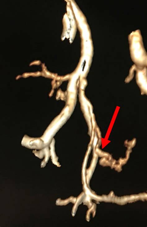 Prostatic Artery Embolization Indications Preparation Techniques Imaging Evaluation