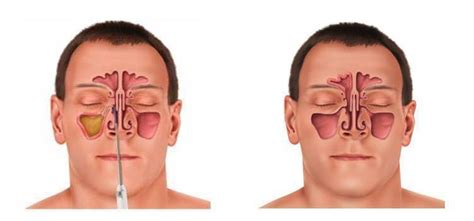 Sinus And Breathing Relief In Los Angeles Sinus Center La