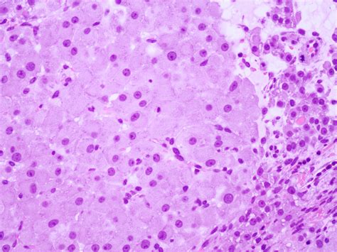 Chocolate Cyst Pathology At Bruce Green Blog