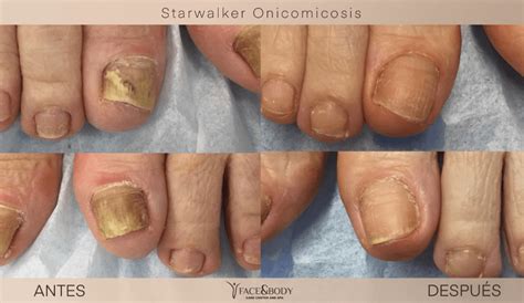 Onicomicosis Face And Body