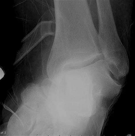 Subtalar Dislocations Trauma Orthobullets